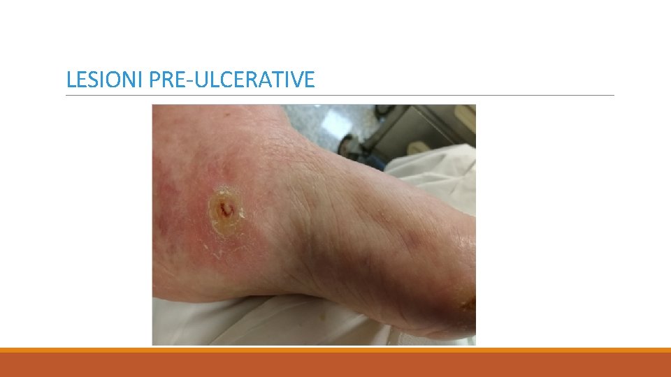 Il Trattamento delle PreLesioni del piede Diabetico Adriano