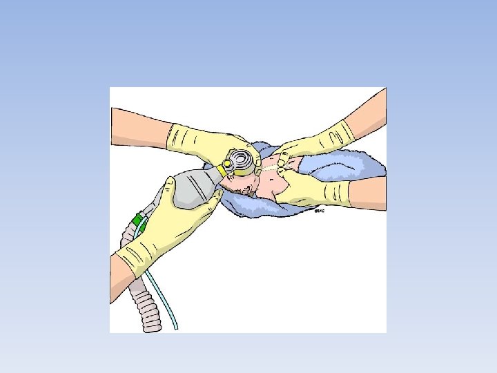 PBLS PALS NLS According to European Resuscitation Council