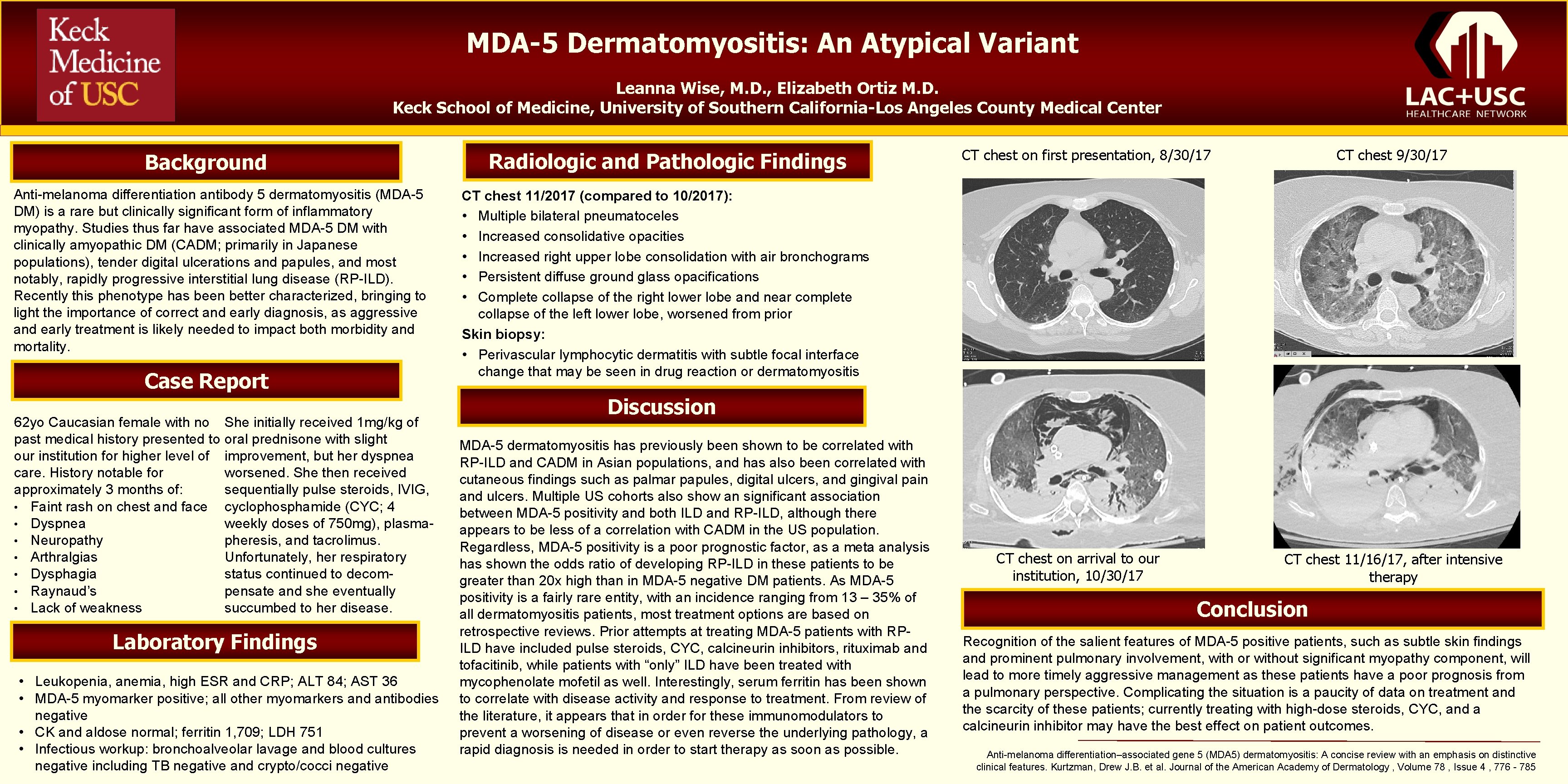 MDA5 Dermatomyositis An Atypical Variant Leanna Wise M