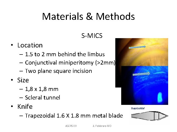 Microincision Cataract Surgery with a Scleral Approach Jean