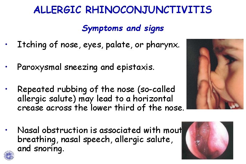 ALLERGIC RHINOCONJUNCTIVITIS Essentials of diagnosis and typical features