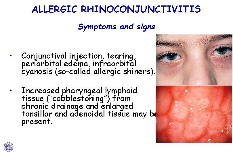 ALLERGIC RHINOCONJUNCTIVITIS Essentials of diagnosis and typical features