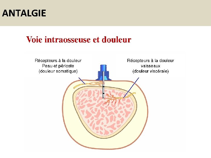 POSE INTRA OSSEUSE avec EZIO Dr Martinez 2019