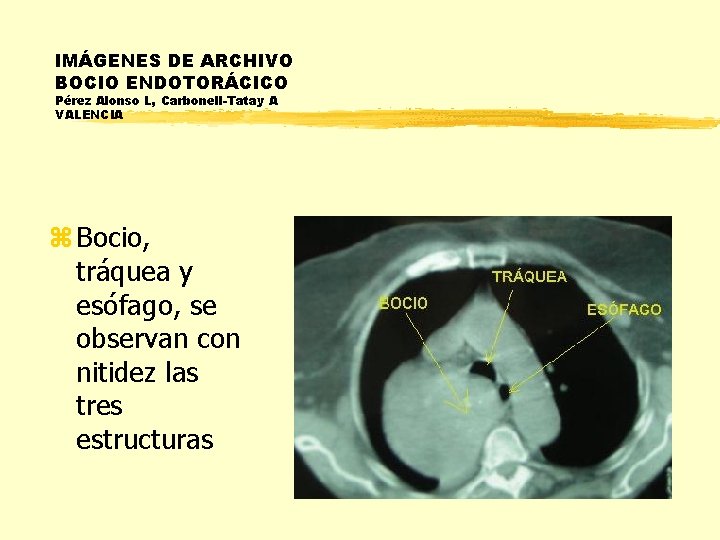 IMGENES DE ARCHIVO BOCIO ENDOTORCICO Prez Alonso L