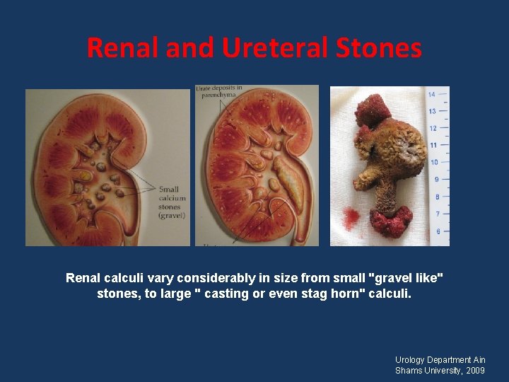Urinary Stones Urolithiasis Urology Department Ain Shams University