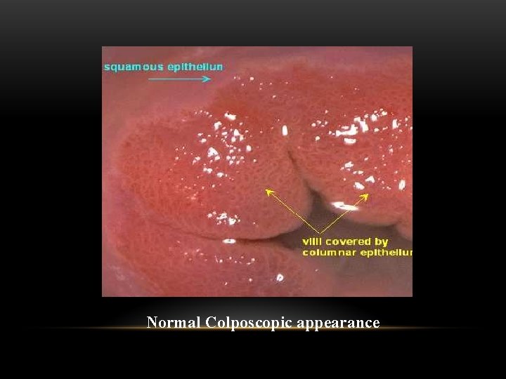 SCREENING FOR FEMALE GENITAL TRACT MALIGNANCY BY Dr