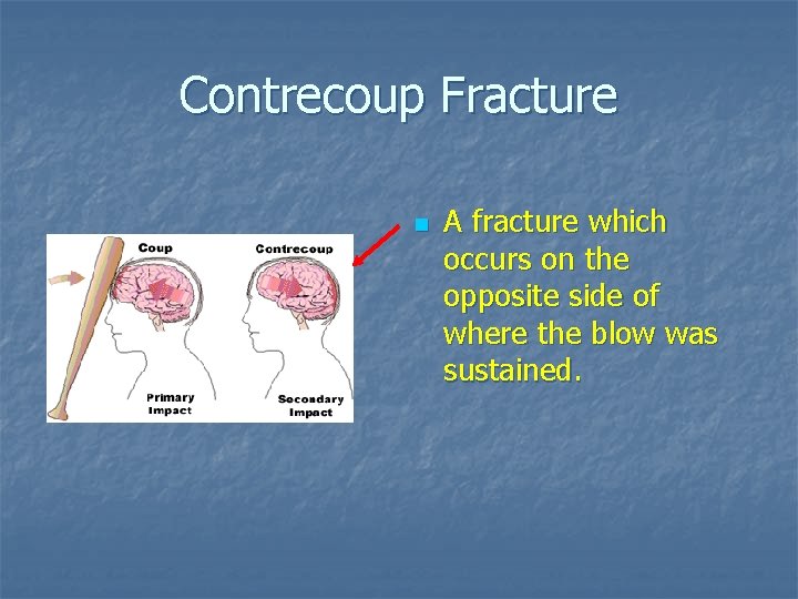 Evaluation Assessment Types of Fractures Bell Work n