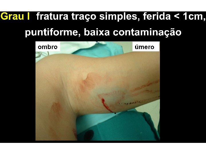 Fratura Exposta Rodrigo Salim Conceito Sempre perceptvel visvel