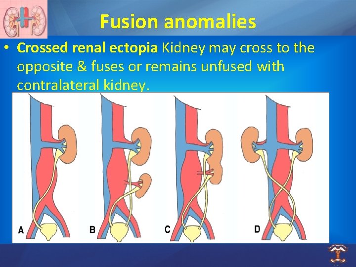 Congenital anomalies of Renal system Objectives To give