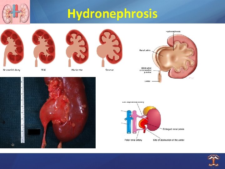 Congenital anomalies of Renal system Objectives To give