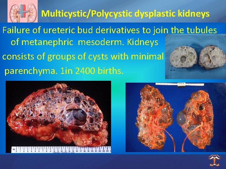 Congenital anomalies of Renal system Objectives To give