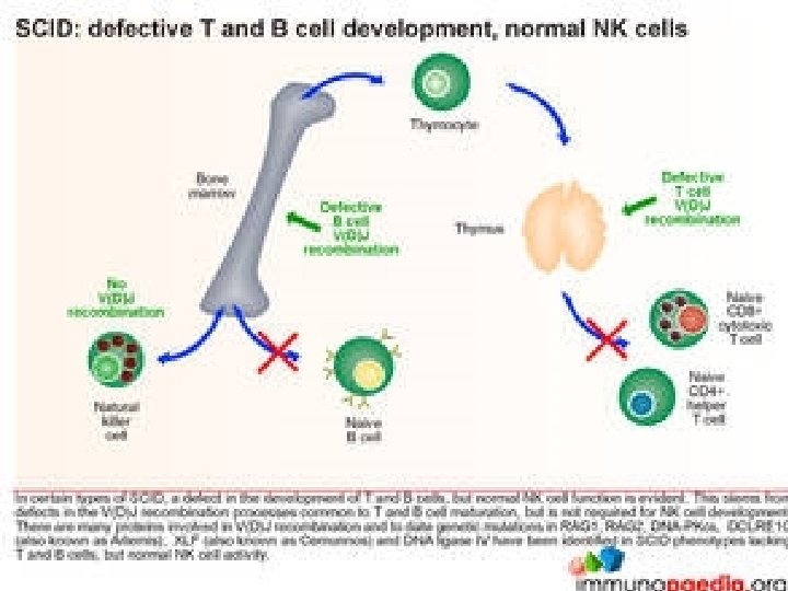 SEVERE COMBINED IMMUNE DEFICIENCY SYNDROME SCID SCIDS XSCID