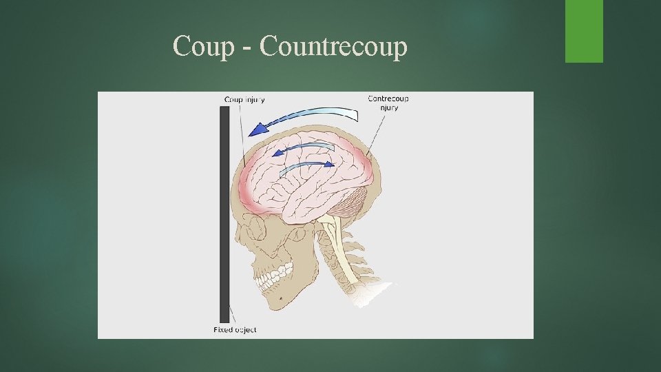 What schools need to know Pediatric Brain Injuries