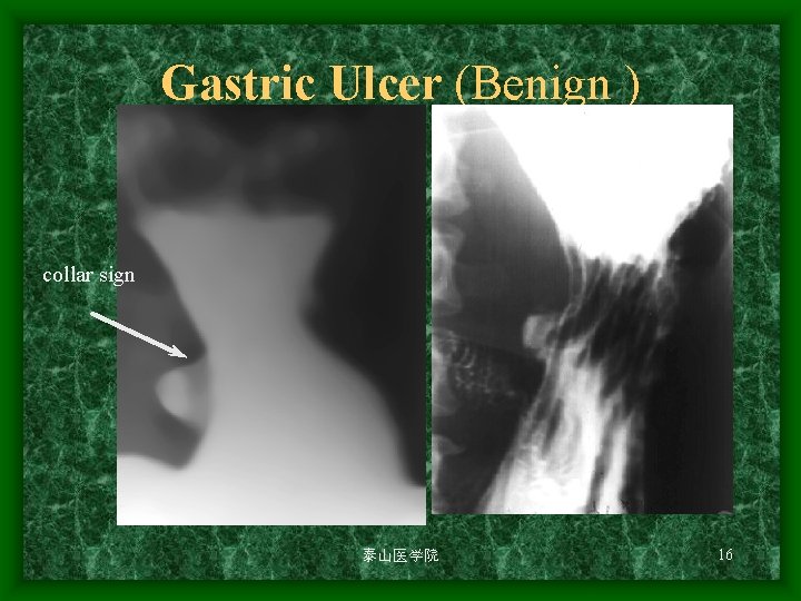 Gastric Diseases 1 Pay attention Gastric Ulcer Carcinoma