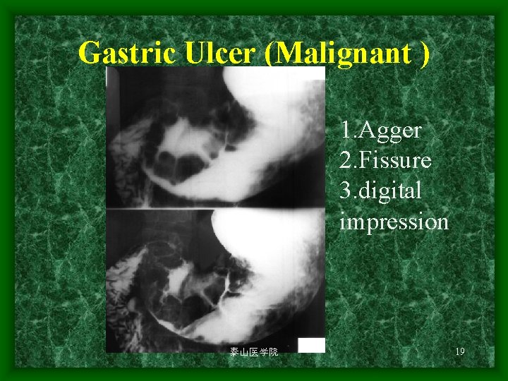 Gastric Diseases 1 Pay attention Gastric Ulcer Carcinoma