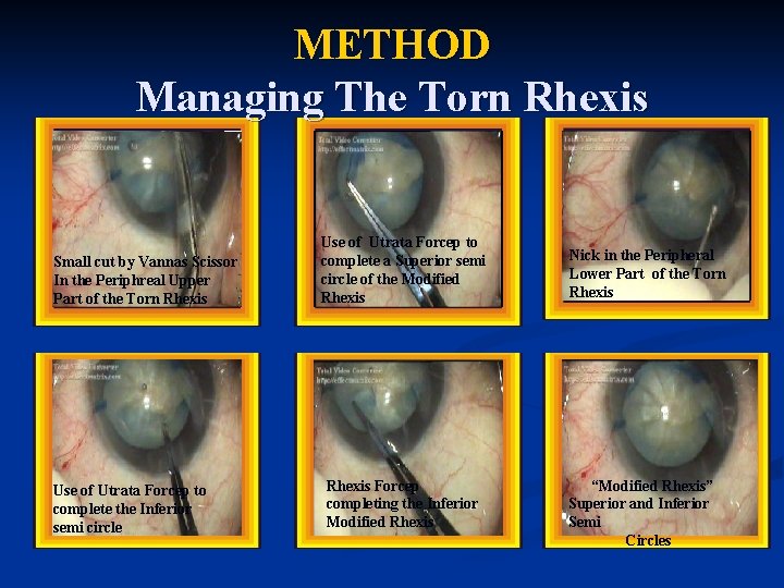 PHACOEMULSIFICATION IN INTUMESCENT MATURE CATARACT Managing a runout