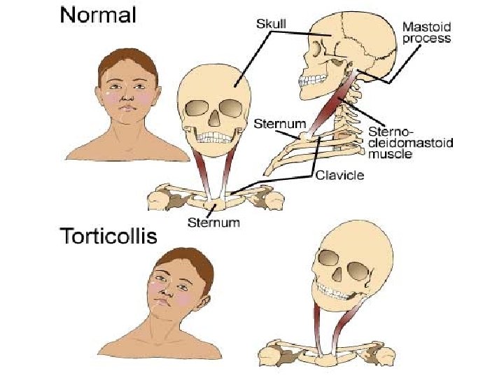 Torticollis wry neck Torticollis also known as wry
