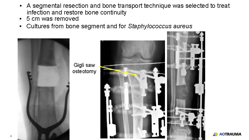 Deformity of Regenerate Bone Following Removal of Circular