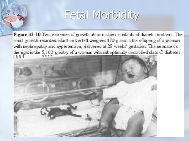 Diabetes in Pregnancy Ryan Agema MS III Diabetes