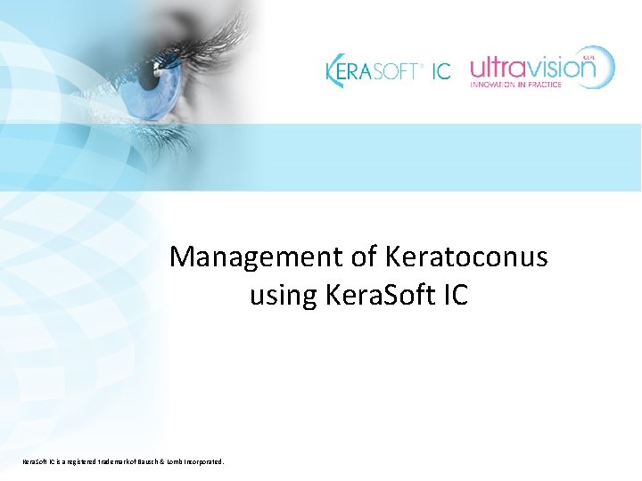 Management of Keratoconus using Kera Soft IC is