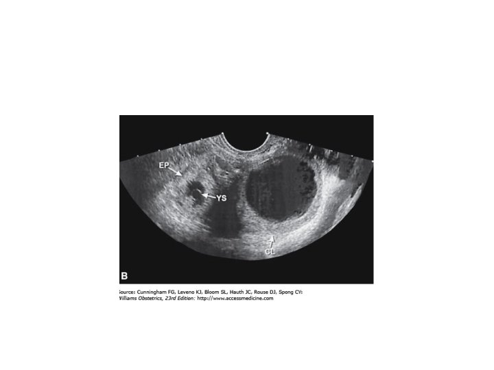 LA GROSSESSE EXTRA UTERINE I DEFINITION La grossesse