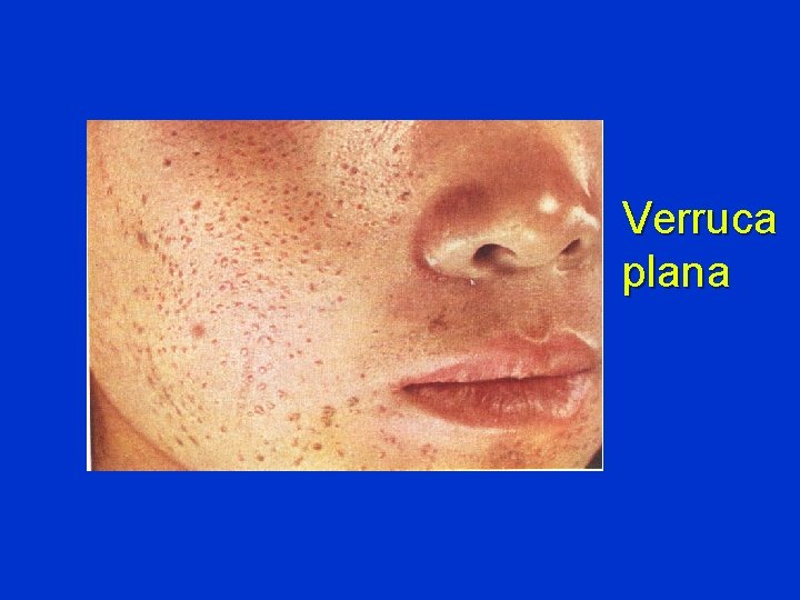 Viral Diseases Clinical classification Vesicle formvesicles dominated such