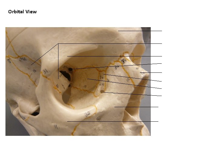 Orbital View Frontal Bone Sphenoid Bone Supraorbital Margin