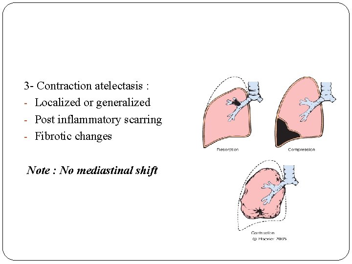 Pathology of the Respiratory System Dr Bushra AlTarawneh