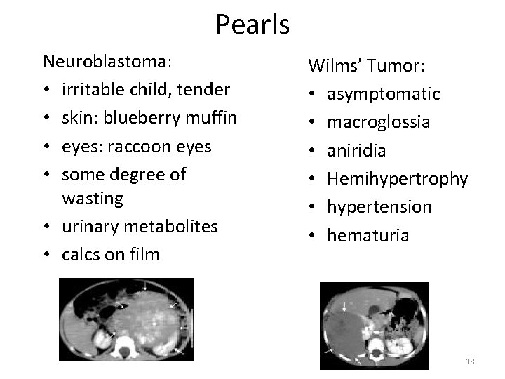Wilms tumor 1 Introduction also known as nephroblastoma