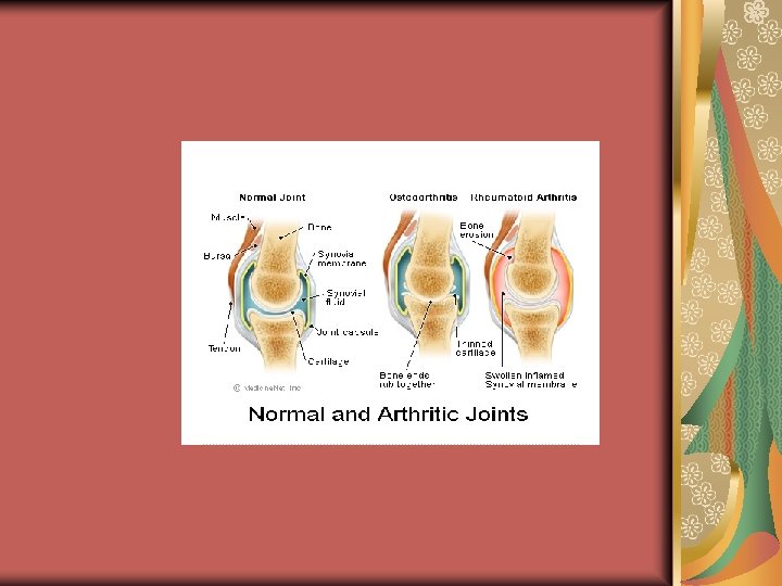 Osteoarthritis Osteoarthritis OA OA is the most common