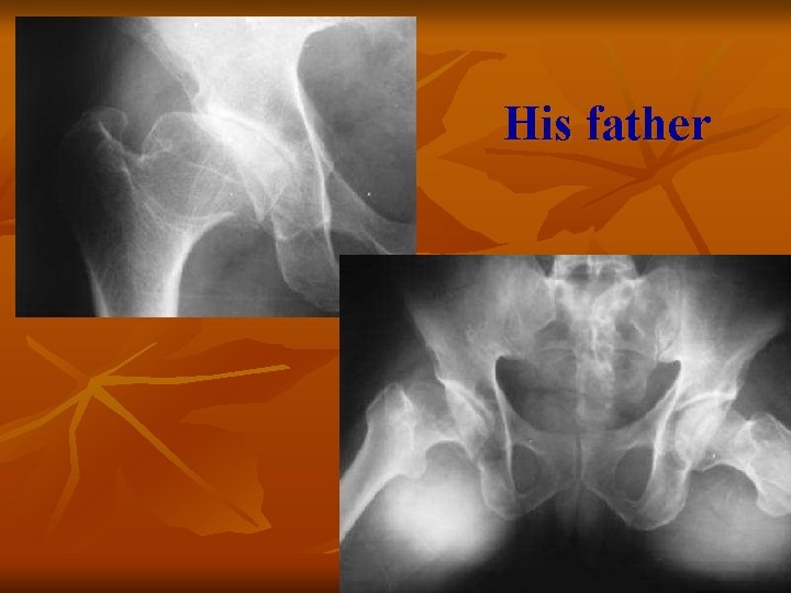 LEGG CALVE PERTHES DISEASE Prepared by Dr Mohamed