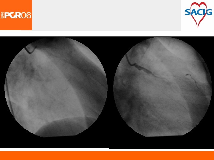 Left Main Coronary Artery Dissection Complicating Diagnostic Coronary