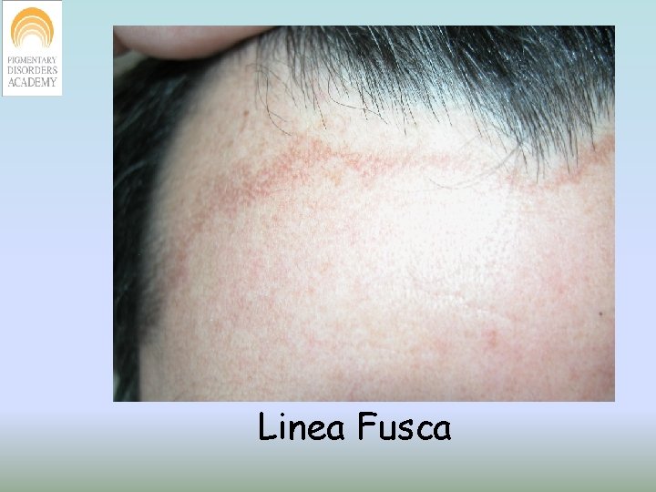 MELASMA Differential diagnosis Greek melas black Complex and