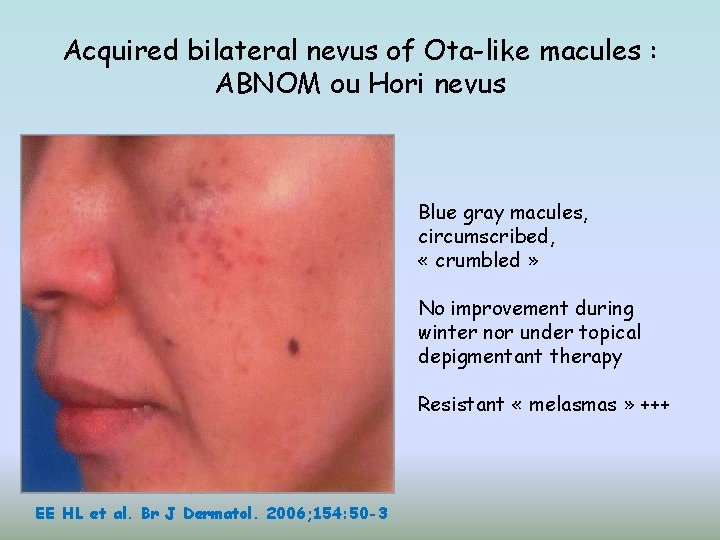 MELASMA Differential diagnosis Greek melas black Complex and