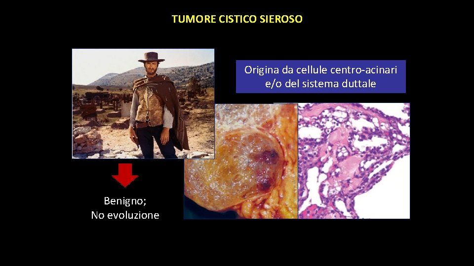 TUMORE CISTICO SIEROSO Origina da cellule centroacinari eo