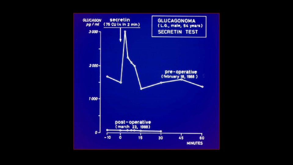 TUMORE CISTICO SIEROSO Origina da cellule centroacinari eo
