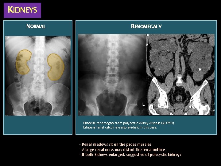 BEYOND THE BOWEL ASSESSING SOFT TISSUE SHADOWS ON