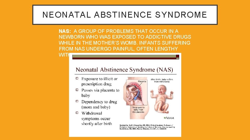 BORN ADDICTED NEONATAL ABSTINENCE SYNDROME By Jessica Gutierrez