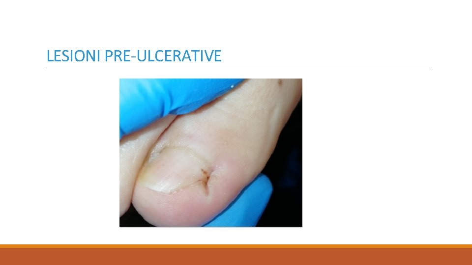 Il Trattamento delle PreLesioni del piede Diabetico Adriano