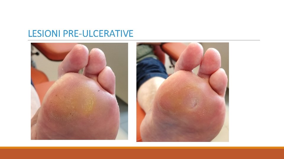 Il Trattamento delle PreLesioni del piede Diabetico Adriano