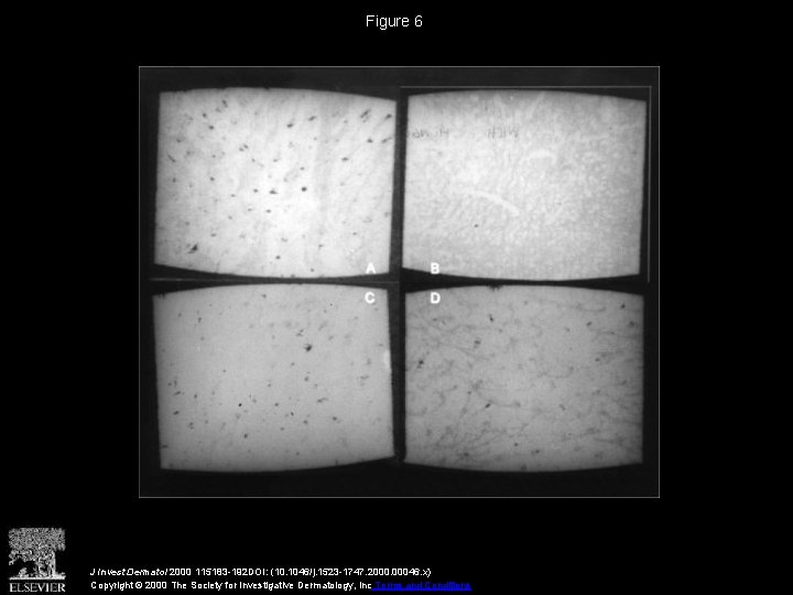Topical ALAPhotodynamic Therapy for the Treatment of Acne