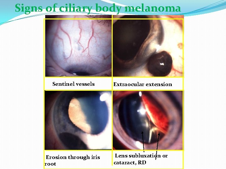 Ocular tumours Dr Raja S Bengharbia The conjunctiva