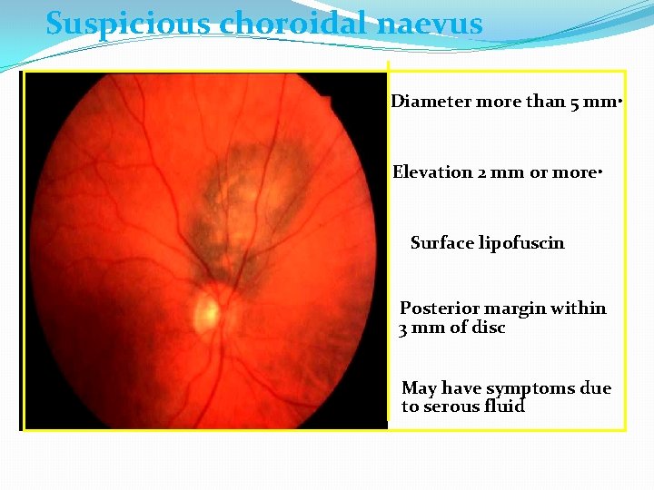 Ocular tumours Dr Raja S Bengharbia The conjunctiva