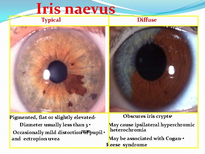 Ocular tumours Dr Raja S Bengharbia The conjunctiva