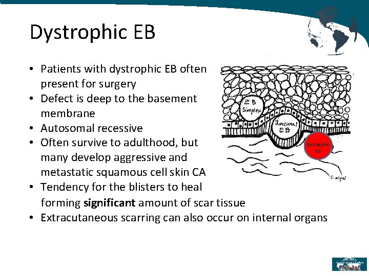 Epidermolysis Bullosa An Anesthetic Challenge Updated 102019 Gail