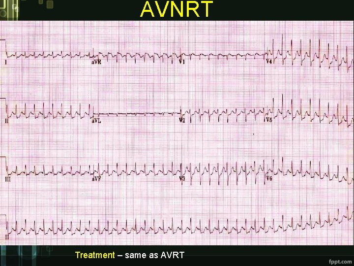 Pediatric arrhythmias Conduction system of heart ECG waves