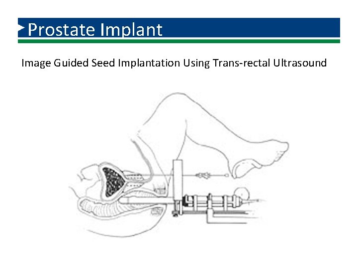 Permanent Brachytherapy Medical Events Experiences of Pennsylvania Frank