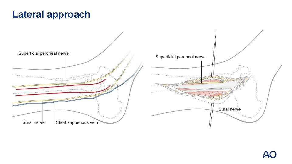 Talar neck fractures and complications AO Trauma Advanced