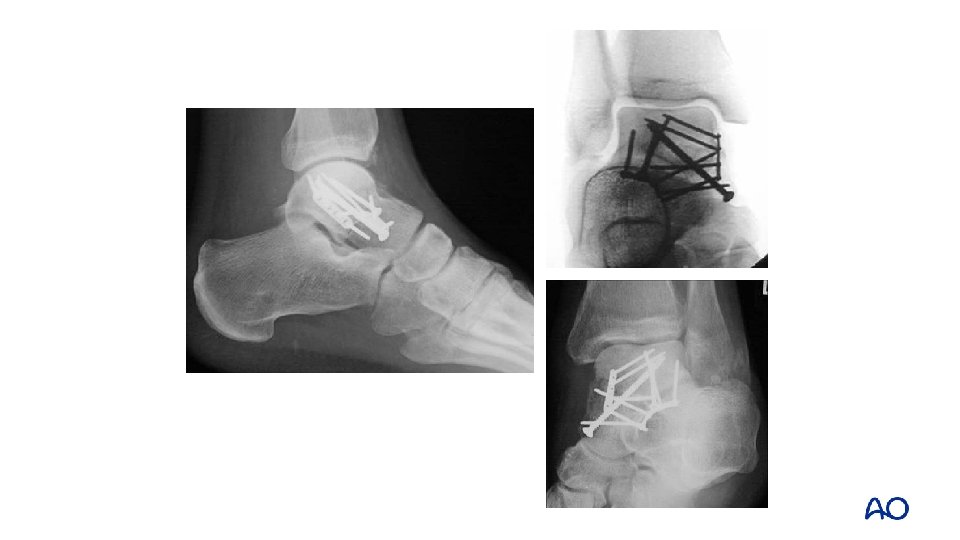Talar neck fractures and complications AO Trauma Advanced