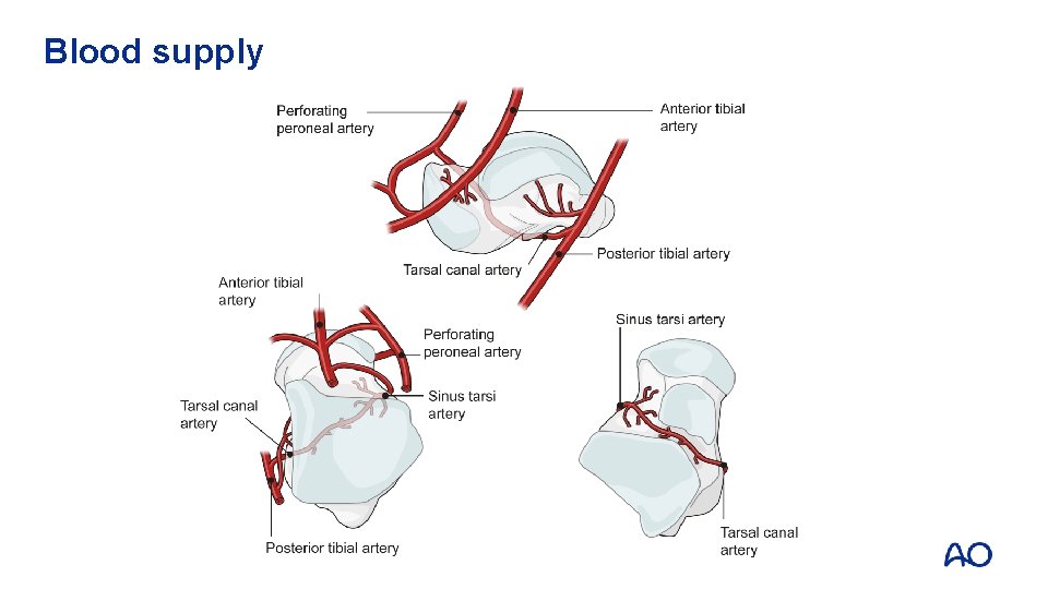 Talar neck fractures and complications AO Trauma Advanced